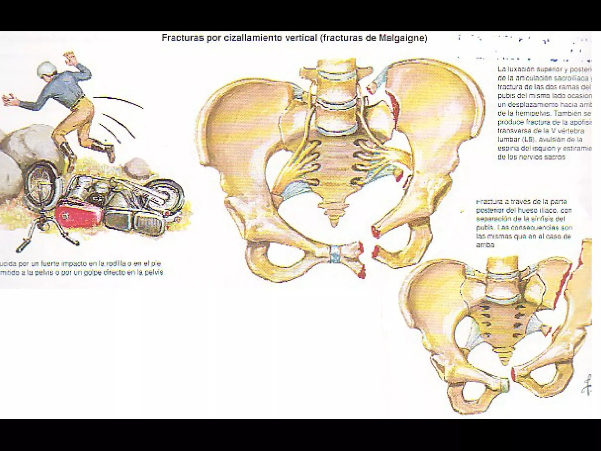 Traumatismo de pelvis | PPT