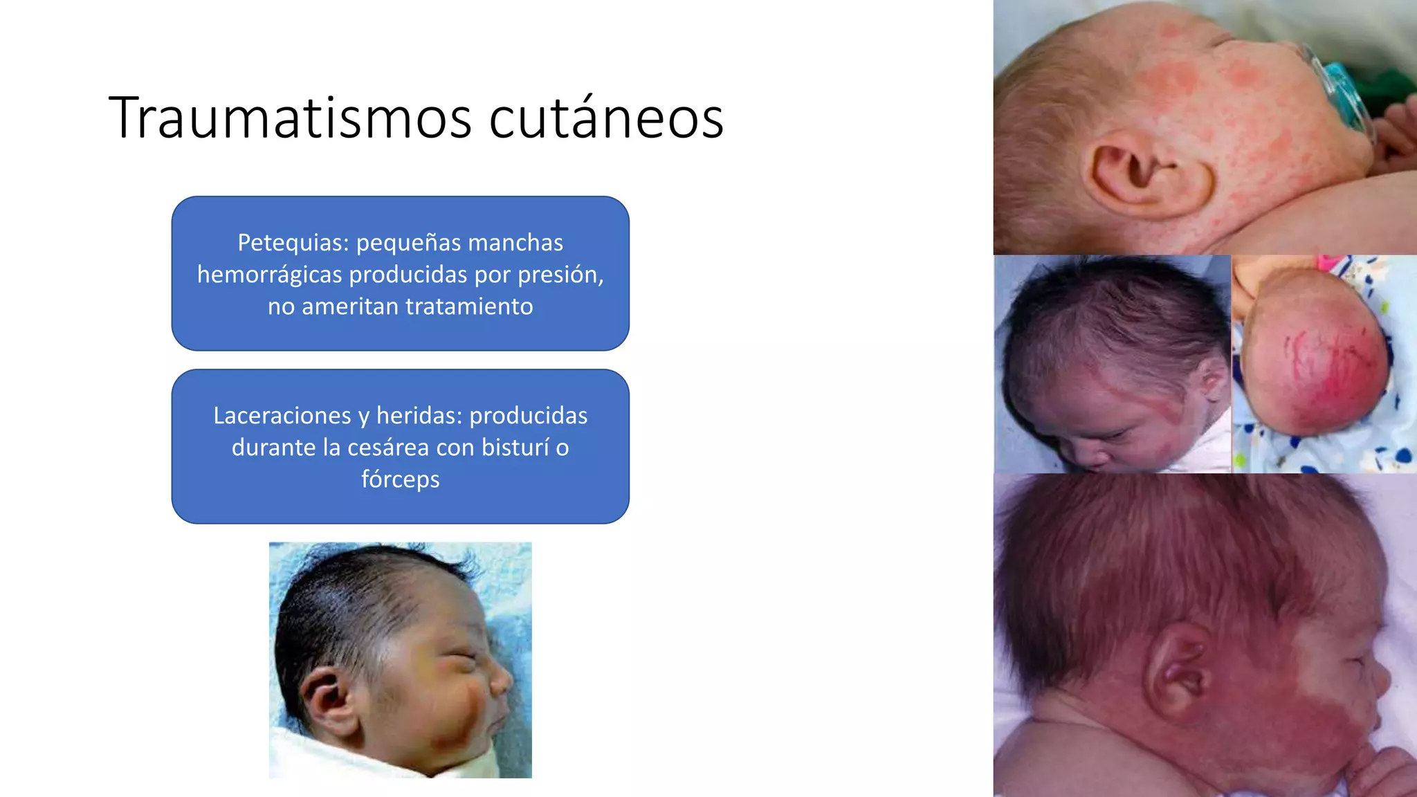traumatismo durante el parto.pptx