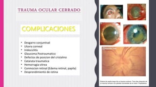TRAUMATISMO OCULAR.pptx