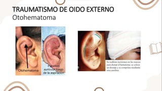 TRAUMATISMOS DEL OIDO. Residencia de otorrinolaringologia. | PPT