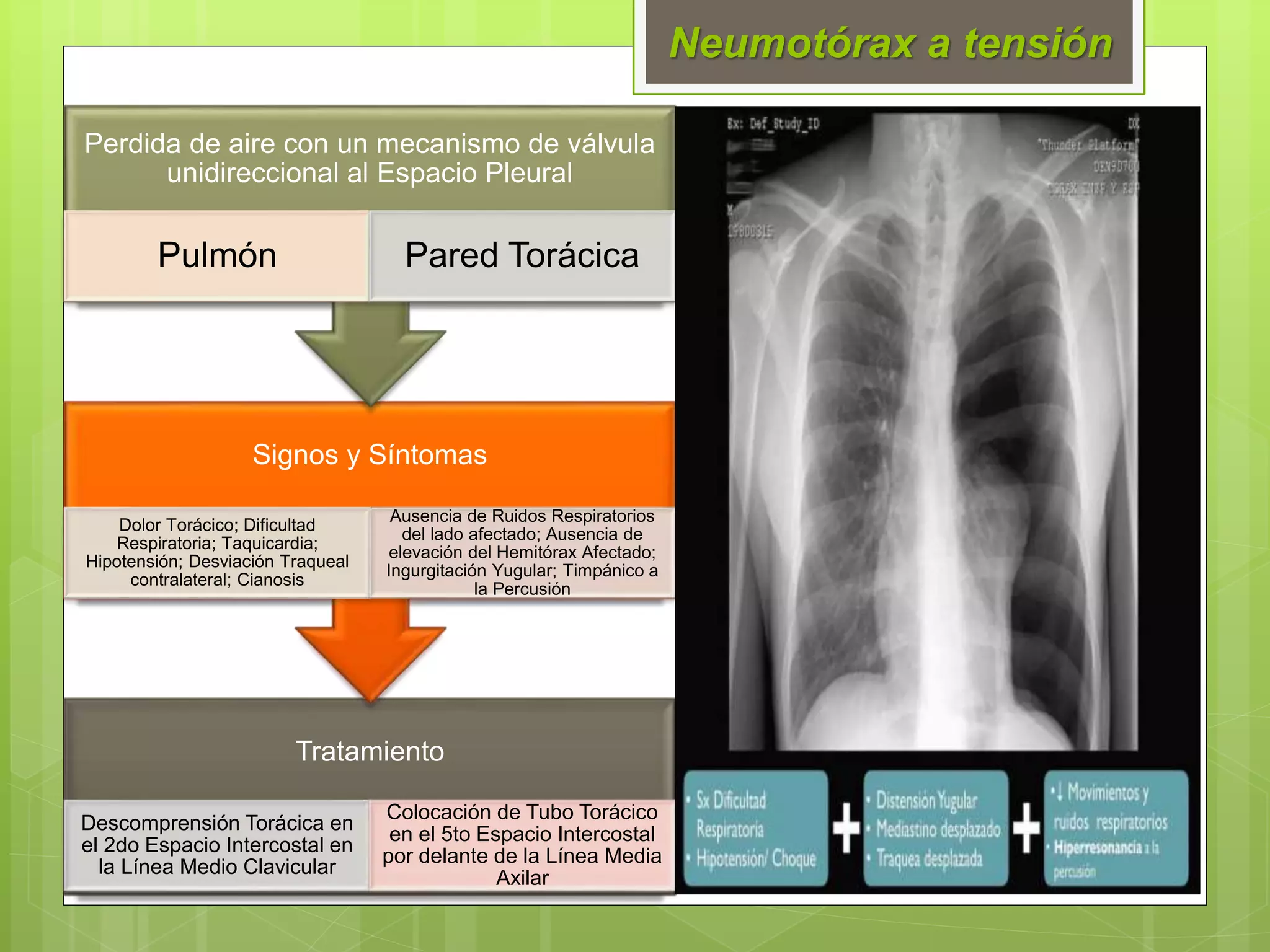 Protocolo de Traumatismo Toracico Hospitalario | PPT