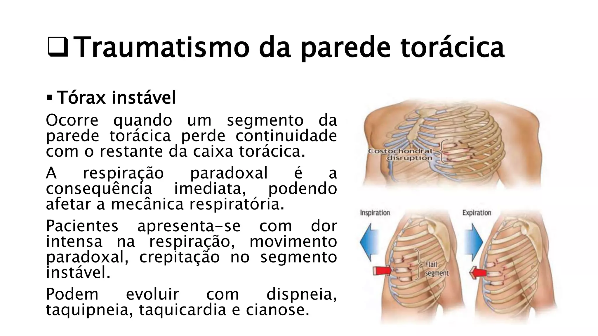 Traumatismo toracico final.pptx