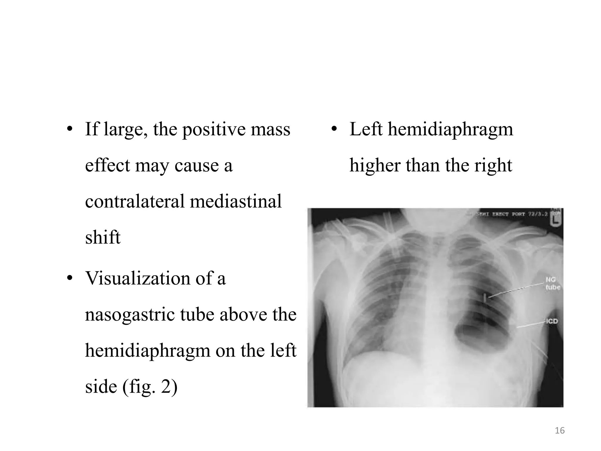 Physiotherapy Management of Traumatized Diaphragm | PPTX