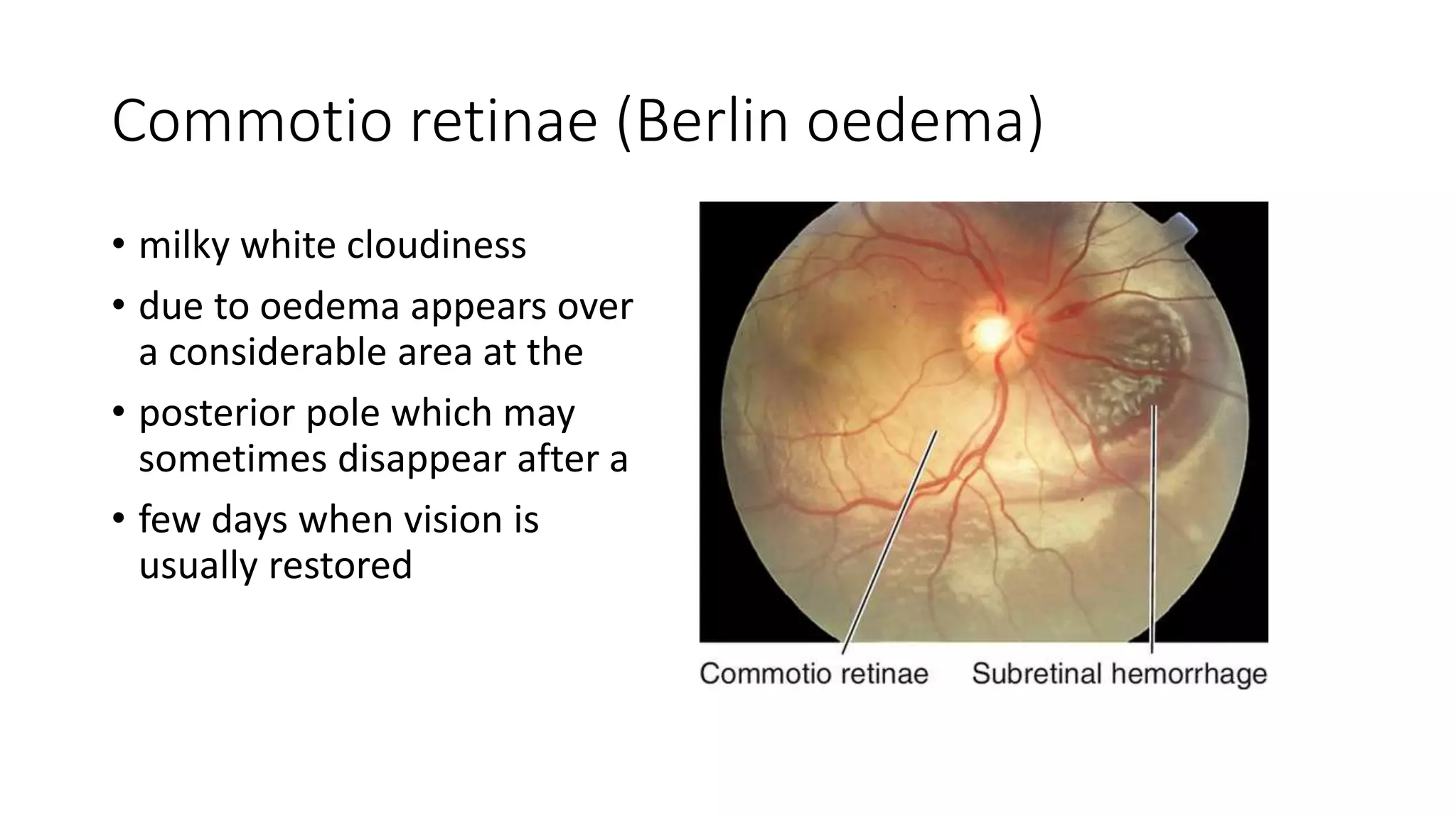 Trauma To Eye Revision Notes Pptx