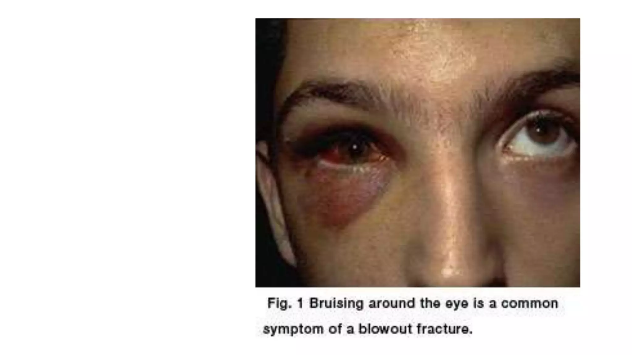 Trauma to eye REVISION NOTES | PPTX