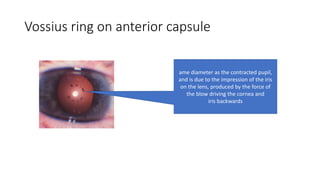 Trauma to eye REVISION NOTES | PPTX