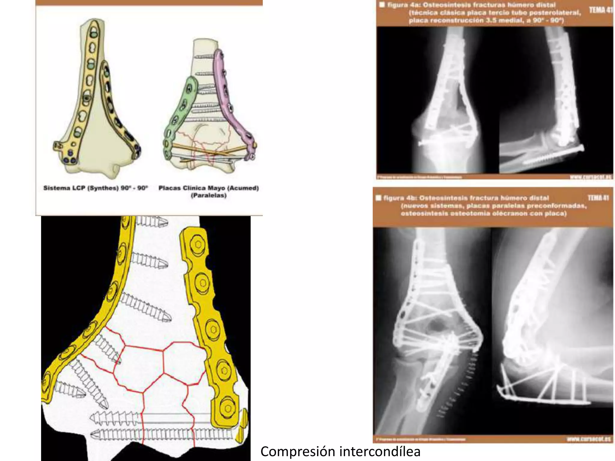 FRACTURA DE HUMERO DISTAL | PPTX