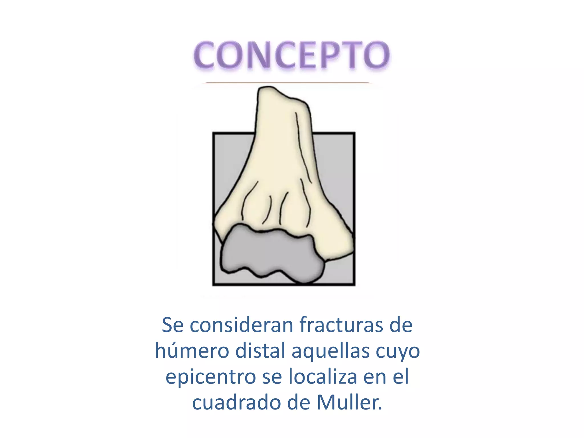 FRACTURA DE HUMERO DISTAL | PPTX