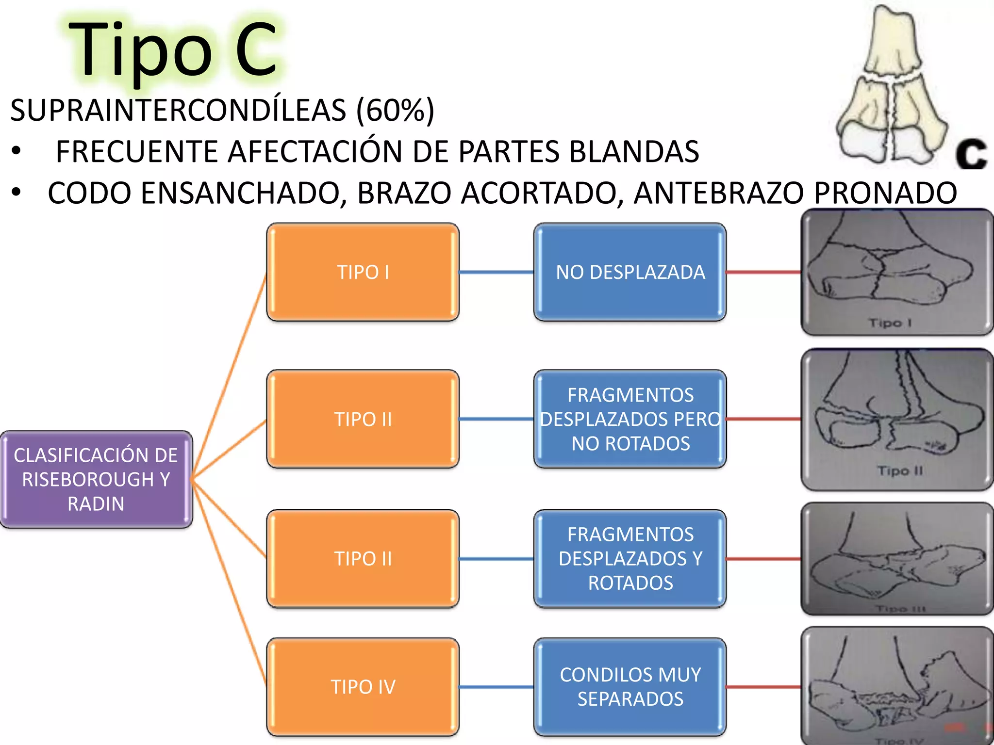 FRACTURA DE HUMERO DISTAL | PPTX