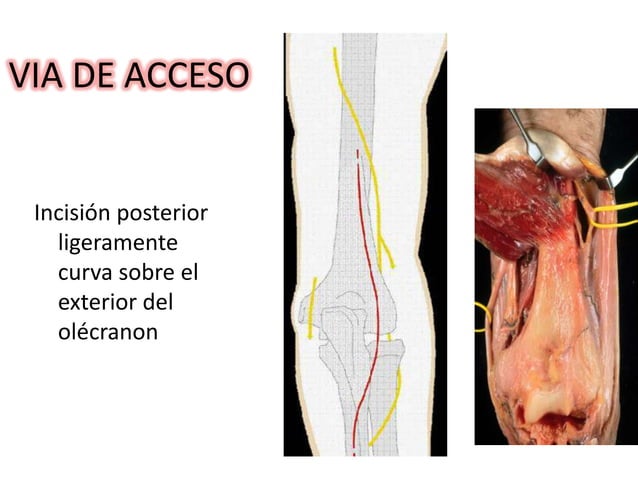 FRACTURA DE HUMERO DISTAL | PPTX