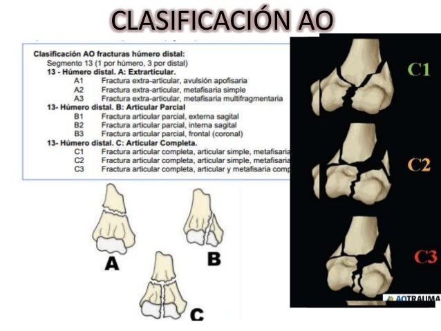 FRACTURA DE HUMERO DISTAL