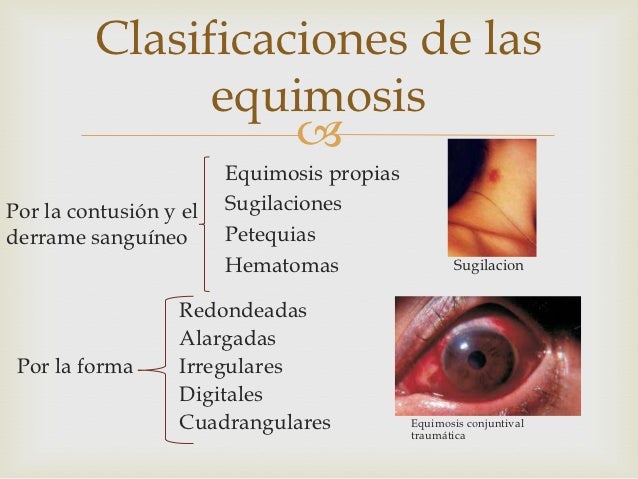 Qu Es La Equimosis