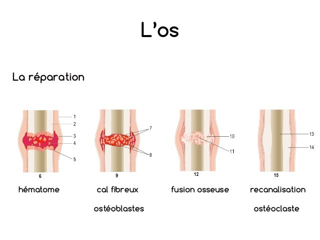 Def Cal Osseux – Cal sur l’os : causes, objectif, délai de guérison – QMHAN