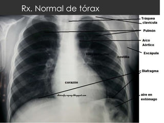 Trauma toracico.urg