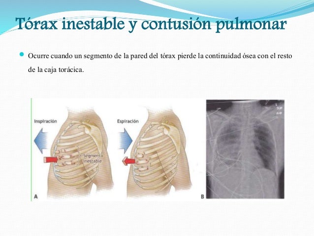 Contusion Pulmonar