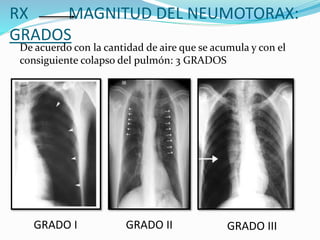 Trauma Toracico Pptx