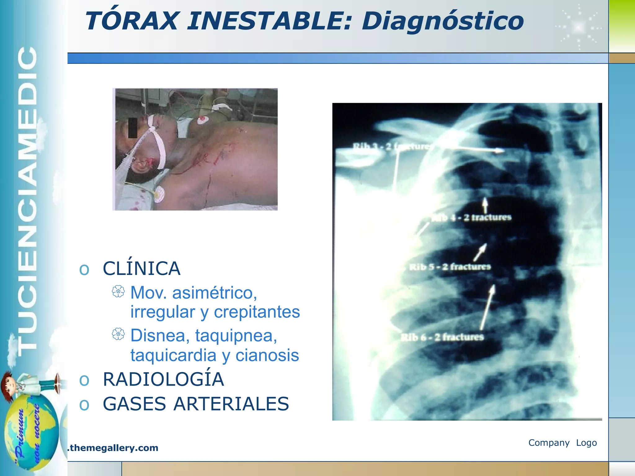 Trauma Toracico FMH UNPRG TUCIENCIAMEDIC | PPT