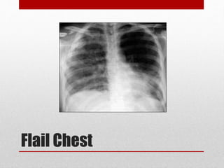 TRAUMA_TORAKS.pptx