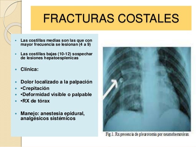 Trauma Torax Dr Membreño