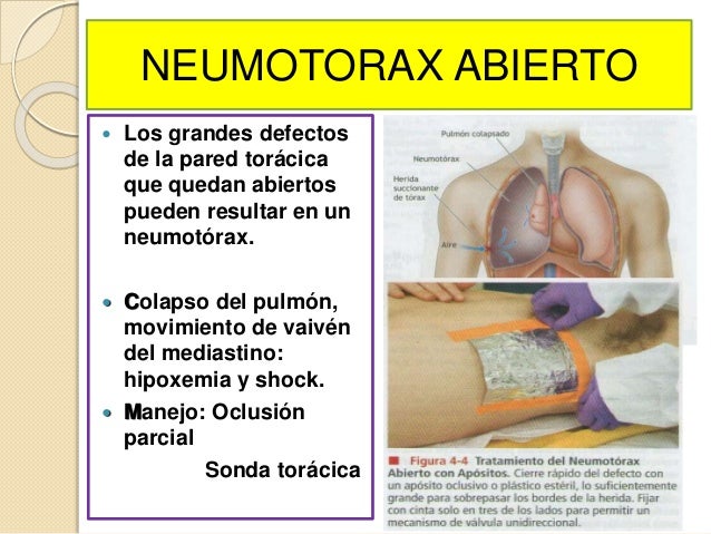 Trauma Torax Dr Membreño