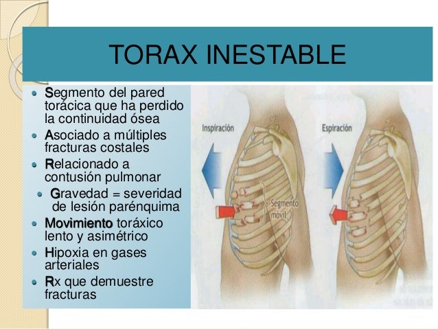 Trauma Torax Dr Membreño