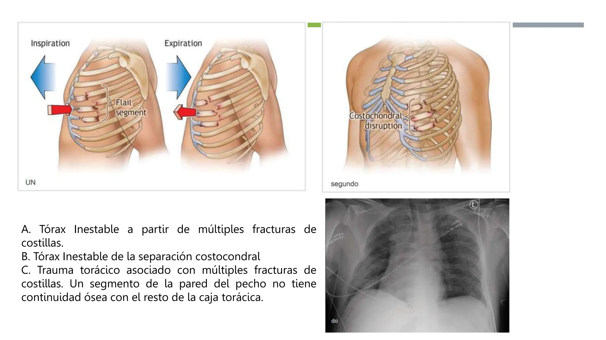 TRAUMA TORÁCICO SEGÚN ATLS. GUÍA 2023 . MEDICINA | PPTX