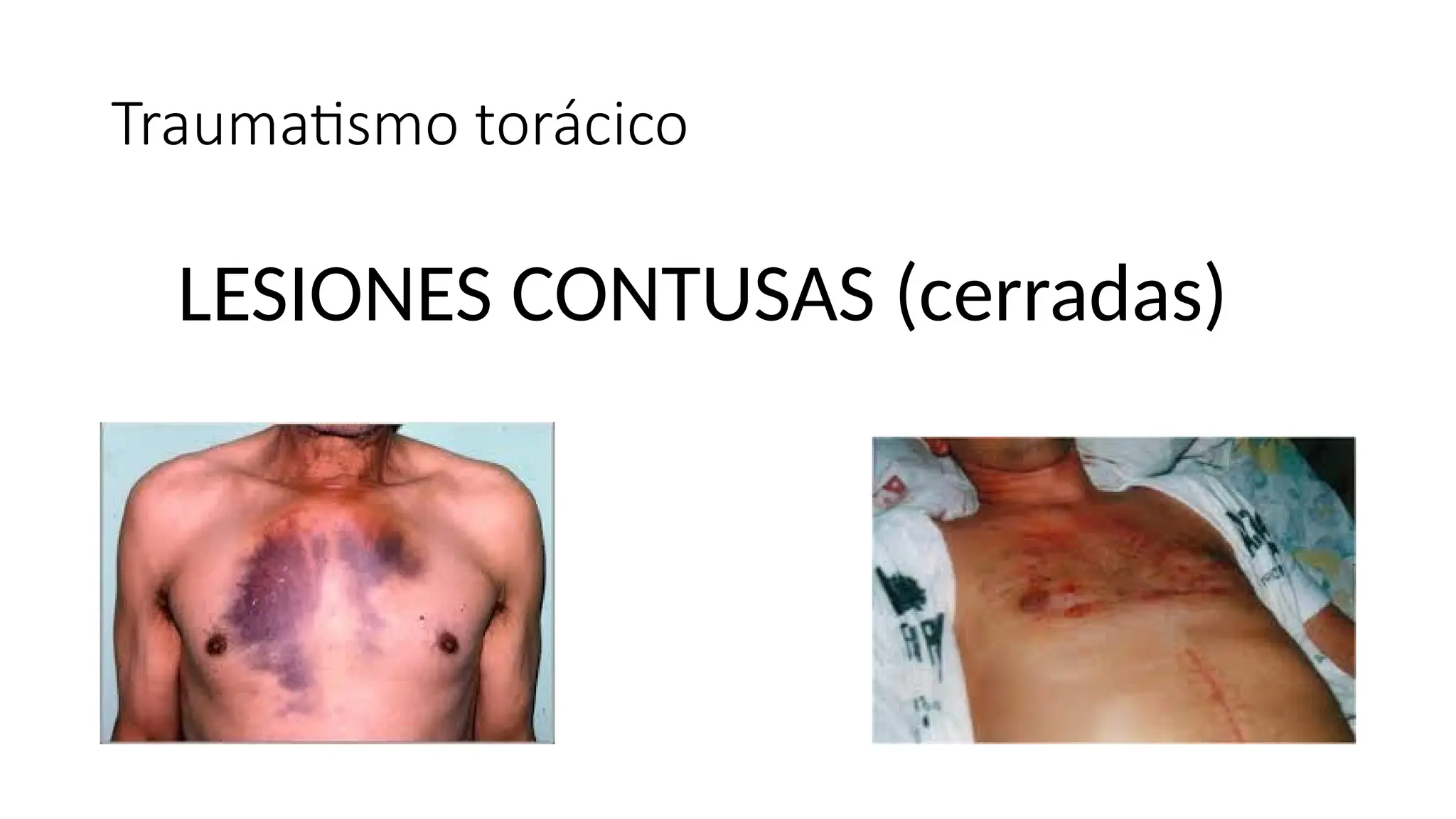 Traumatismo Torácico - Clinica Quirúrgica.pptx