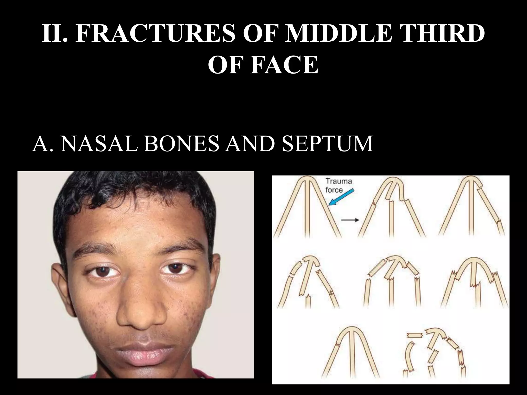 Trauma to the face | PPTX