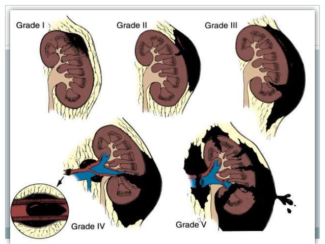 Trauma to the genitourinary tract. | PPTX