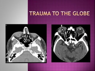 TRAUMA TO THE GLOBE-ocular trauma-1.pptx