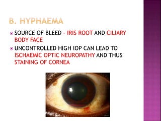 TRAUMA TO THE GLOBE-ocular trauma-1.pptx