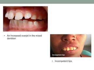 Trauma To The Permanent Maxillary Incisors In The Mixed Dentition And ...