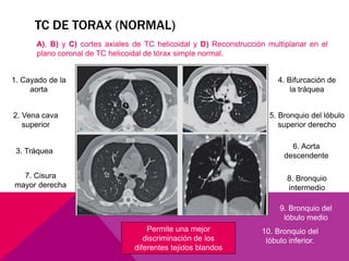 TRAUMATÍSMO TORACICO Y ABDOMINAL.pptx