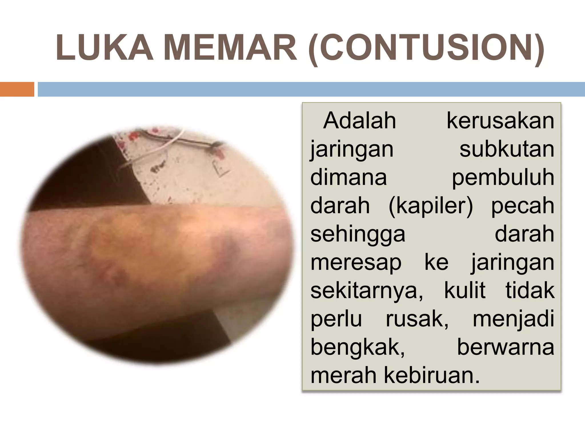 Trauma tumpul | PPTX