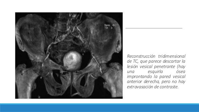 Trauma ureteral y vesical