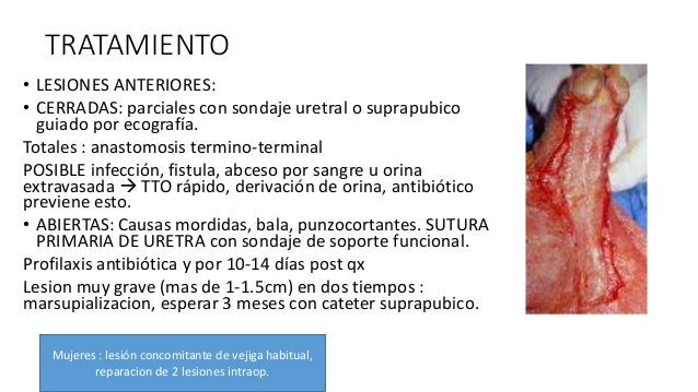 Trauma uretral y vesical urologia