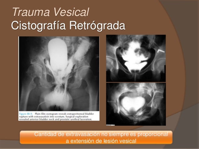 Trauma Vesical