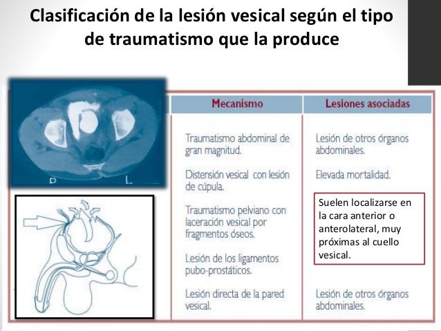 Trauma vesical y genital