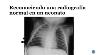 Tórax pediátrico normal rx 2015 | PPTX