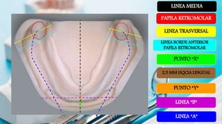 TRAZOS DEL MAXILAR INFERIOR.pptx