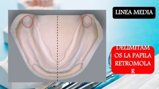 TRAZOS DEL MAXILAR INFERIOR.pptx