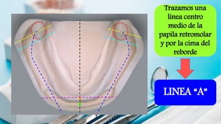 TRAZOS DEL MAXILAR INFERIOR.pptx