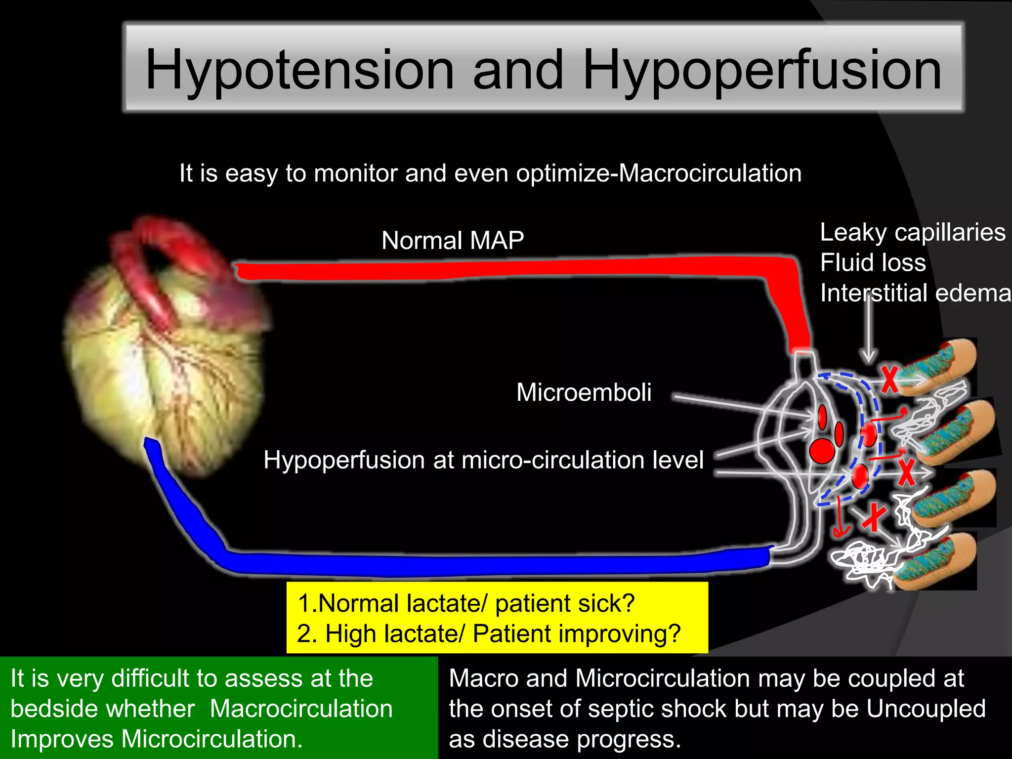 Hypotension management in ICU, volume vessel or pump? | PPTX