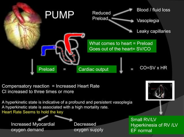 Hypotension management in ICU, volume vessel or pump? | PPTX