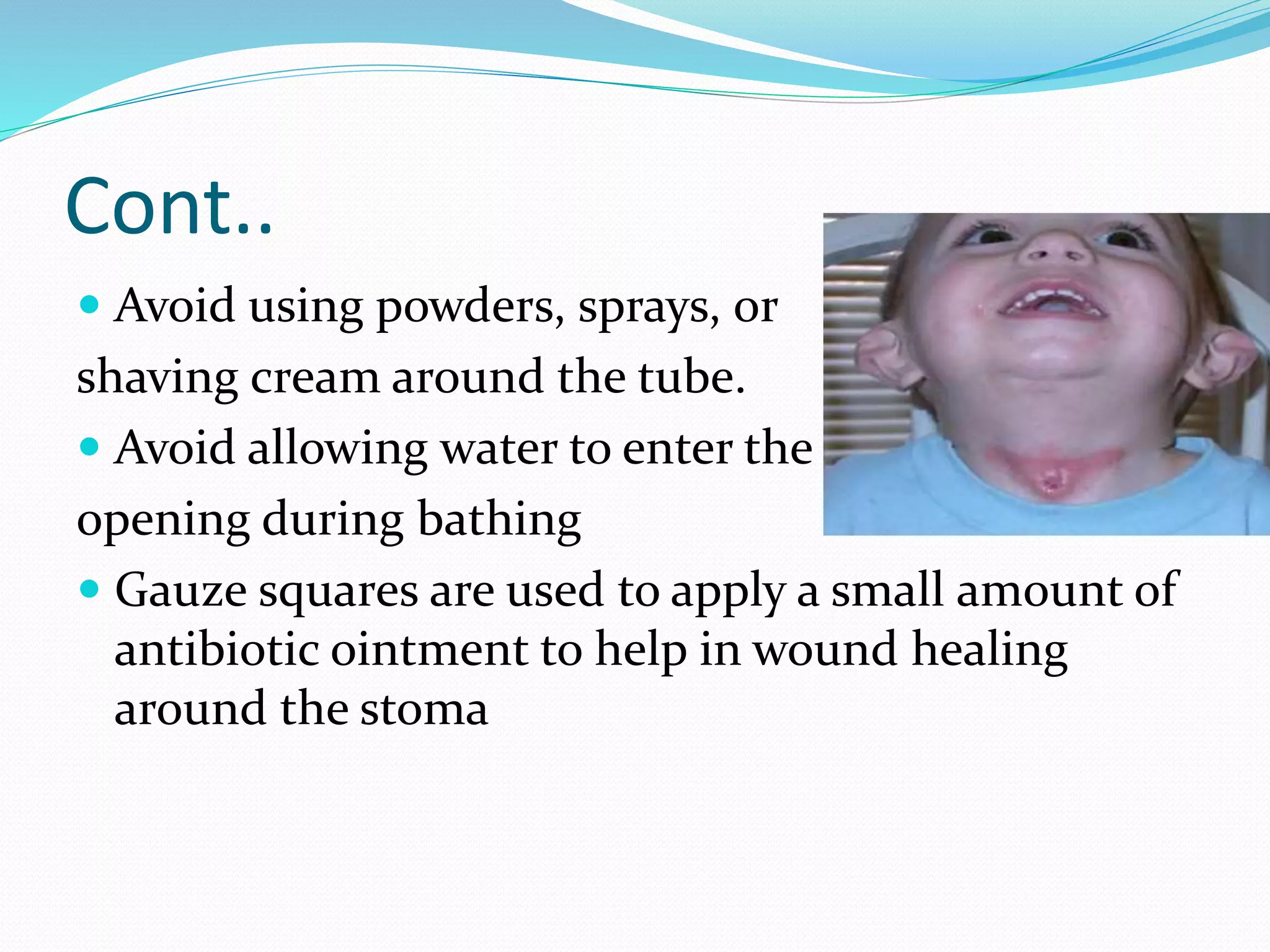Tracheostomy | PPTX