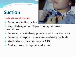 Tracheostomy | PPTX
