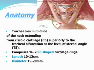 Tracheostomy | PPTX