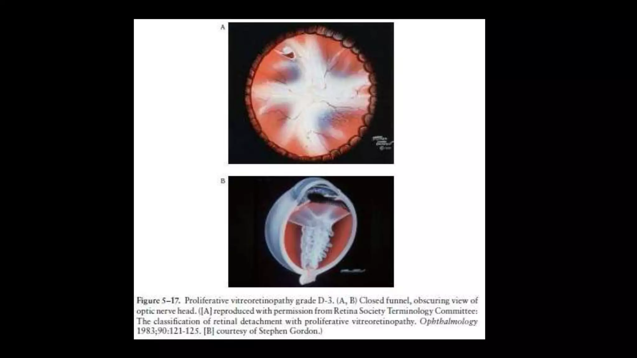 Tractional RD | PPTX