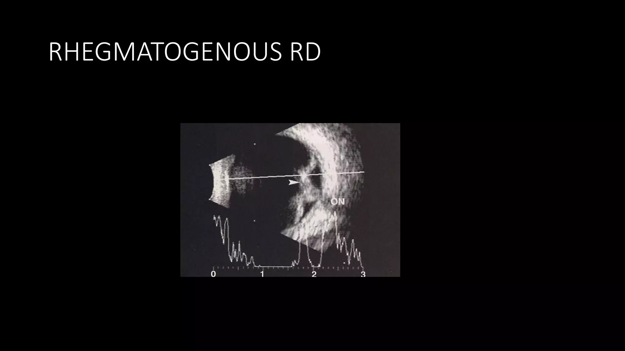 Tractional RD | PPTX