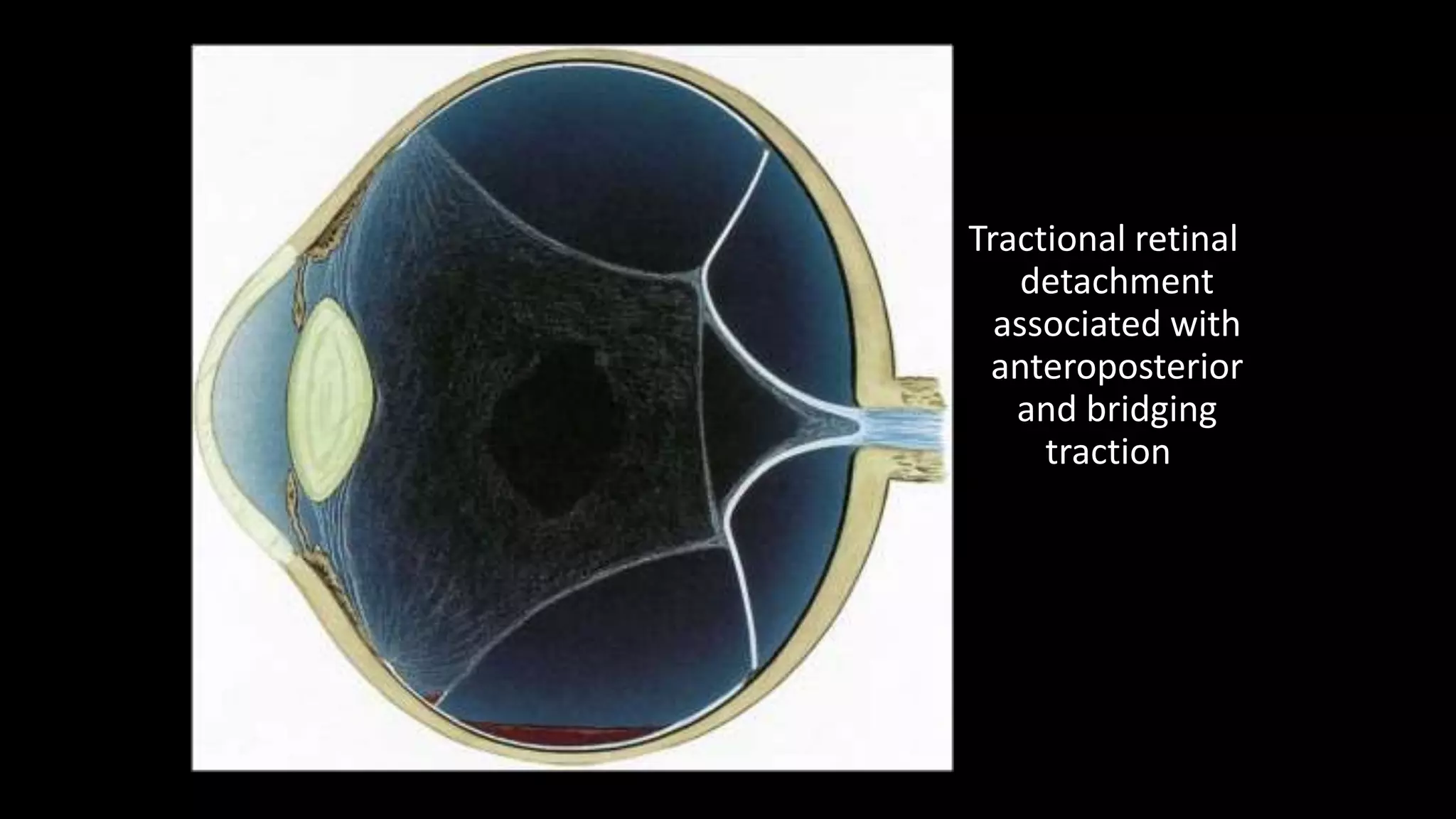 Tractional RD | PPTX